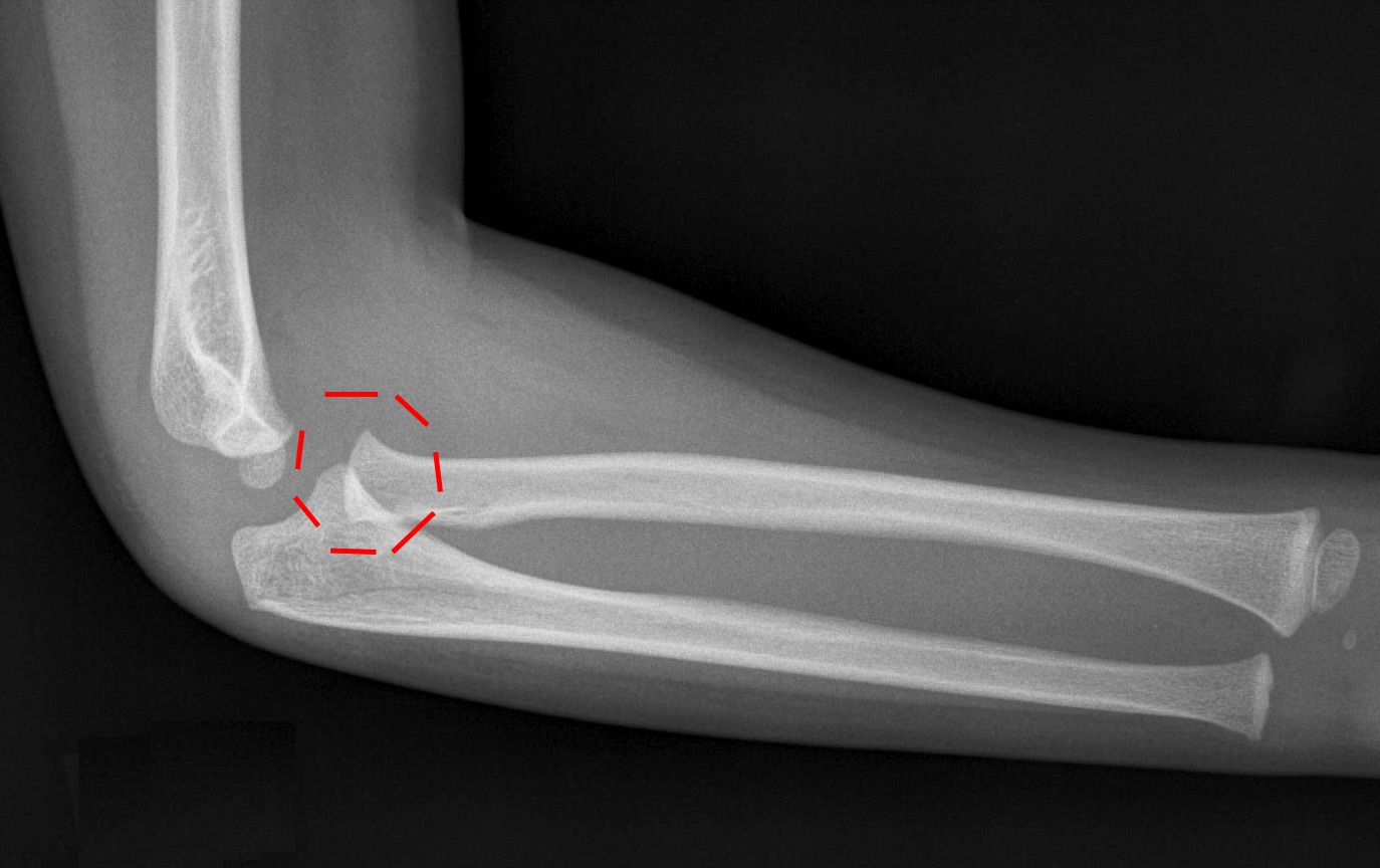 Elbow X Rays Elbow X Rays