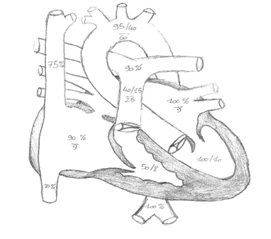 Septal Atrial Types Defects Asd Defect Ventricular Atrioventricular Svc ...