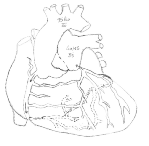 Anomalous left coronary artery (ALCAPA)