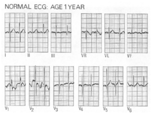 Normal ECGs for various ages - Don't Forget the Bubbles