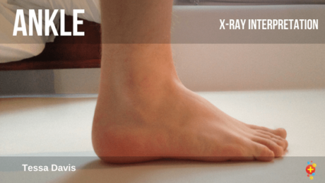 Ankle x-rays
