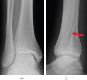 Ankle x-rays