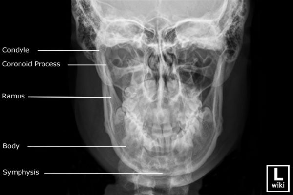 Mandible x-rays