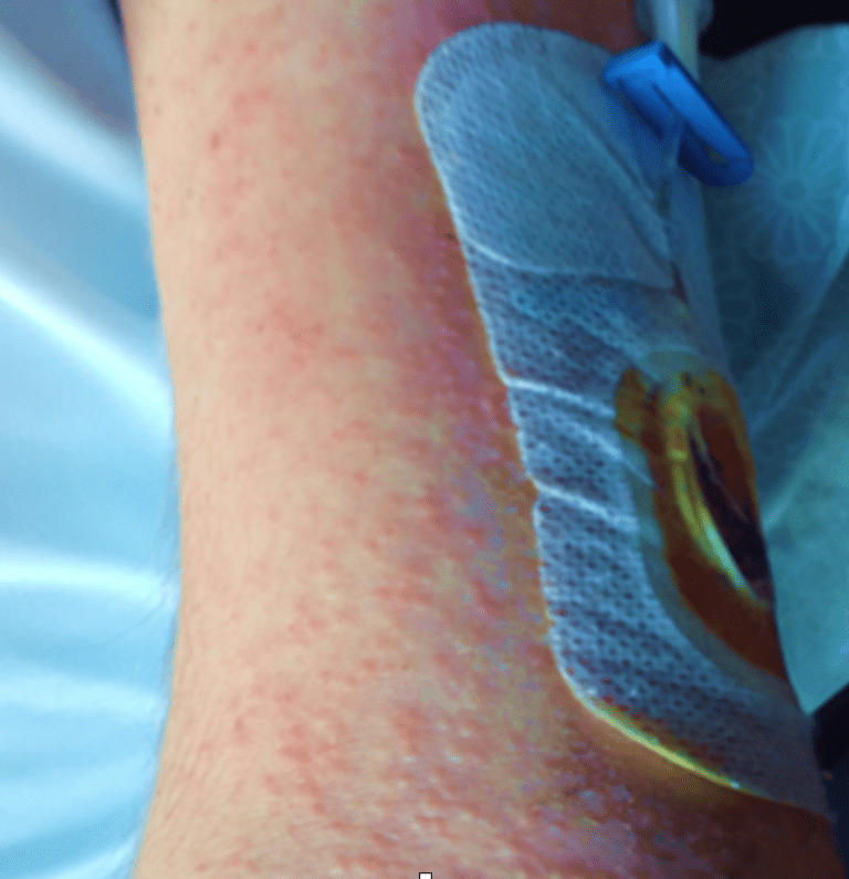 CVADs - a survival guide