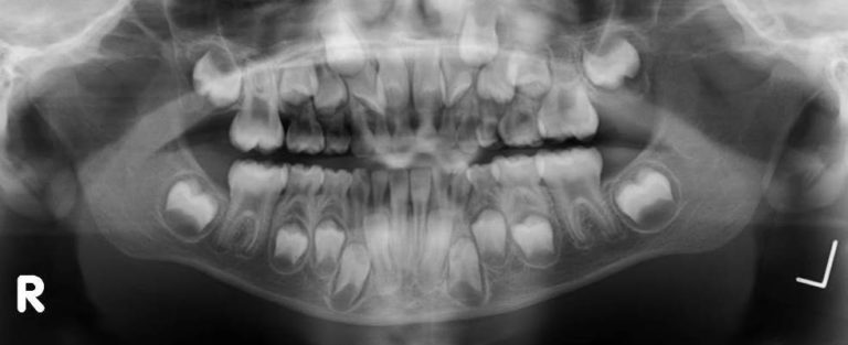 Mandible x-rays