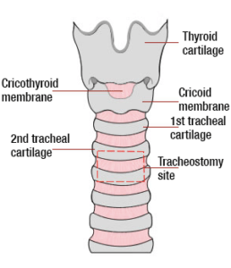 Crash course in tracheostomies