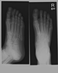 Foot x-rays - Don't Forget the Bubbles