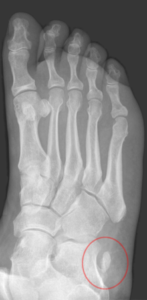 Foot x-rays - Don't Forget the Bubbles