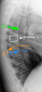 Thoracolumbar spine x-rays
