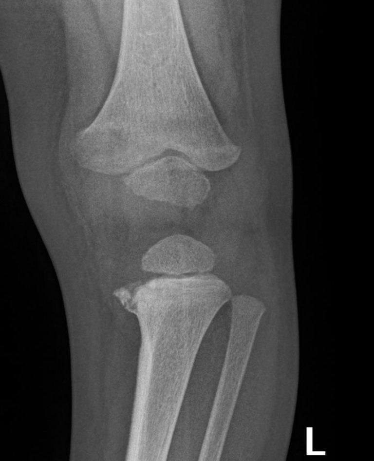 Proximal Tibial Fractures