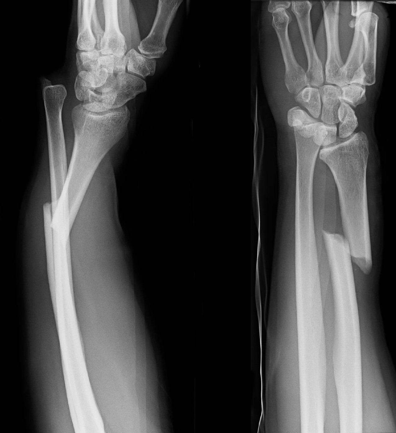 Galeazzi Fracture dislocations LaptrinhX News Galeazzi Fracture dislocations LaptrinhX News
