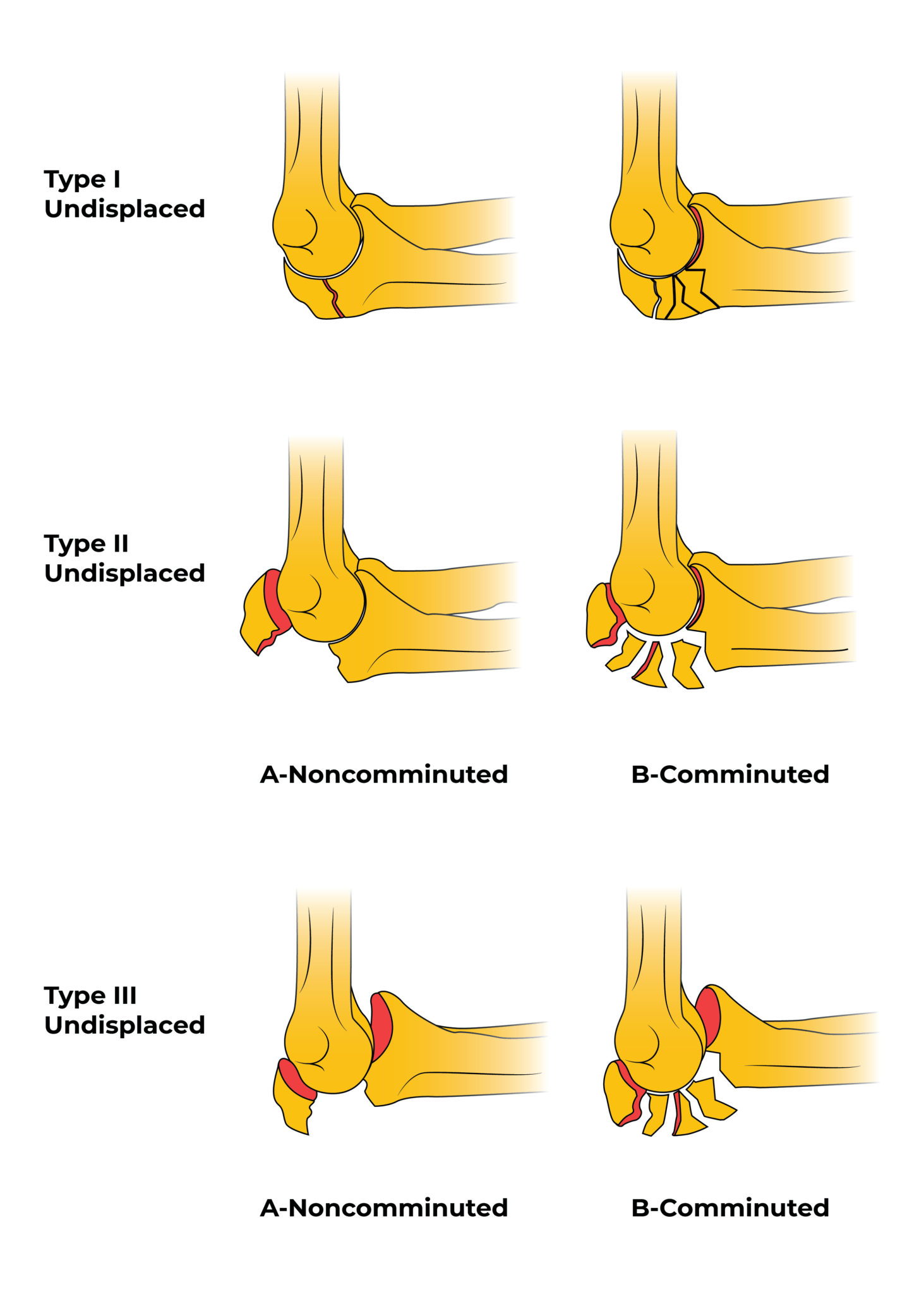 Olecranon fractures Olecranon fractures