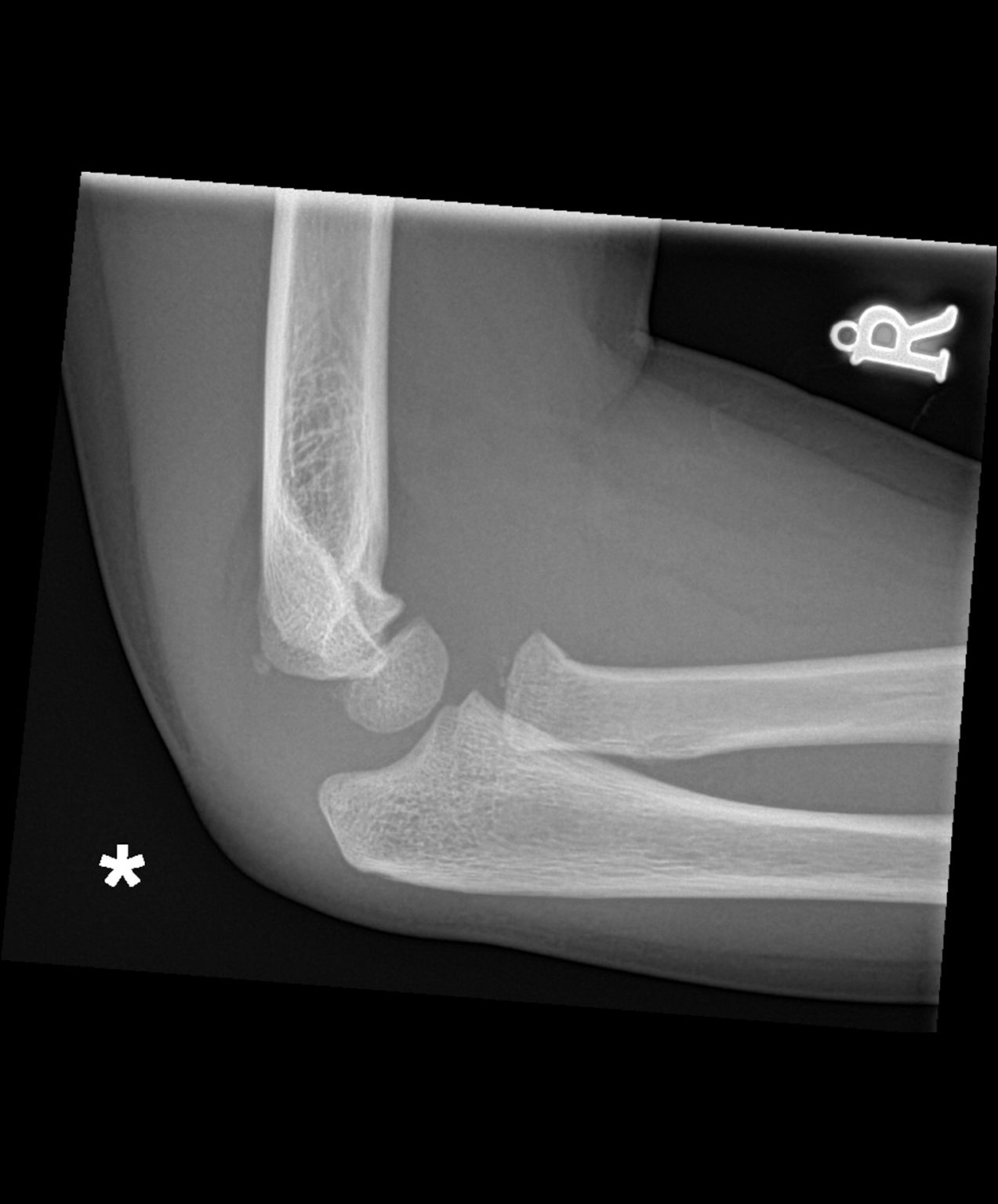 Olecranon fractures