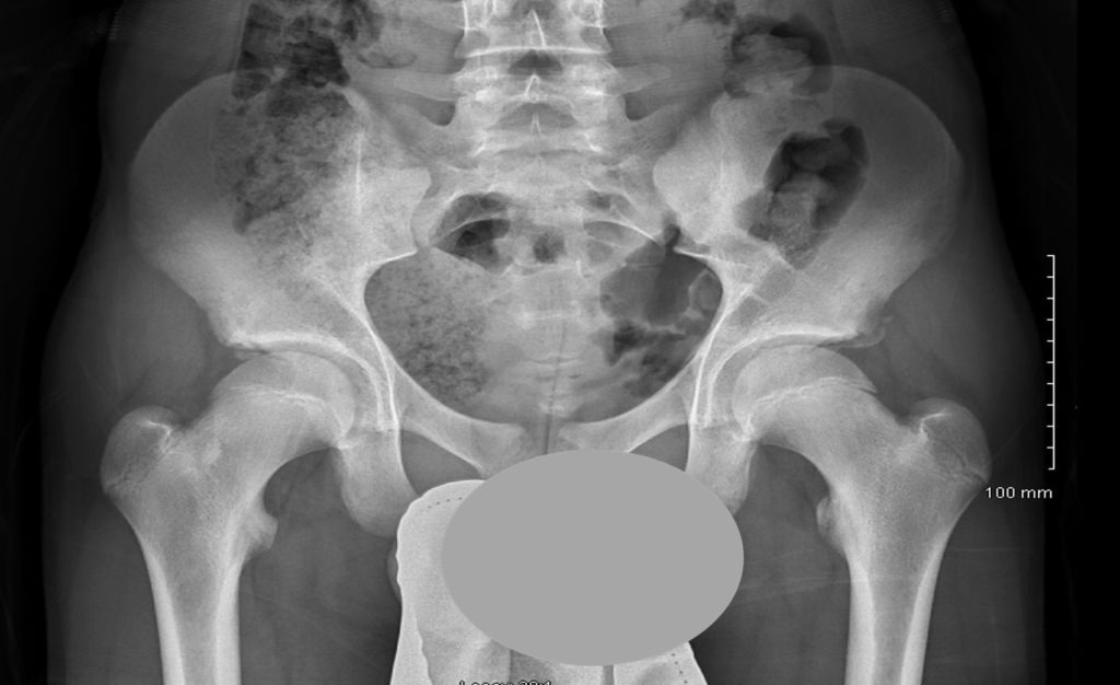 Pelvic avulsion injuries