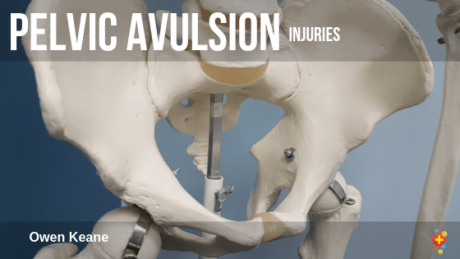 Pelvic avulsion injuries