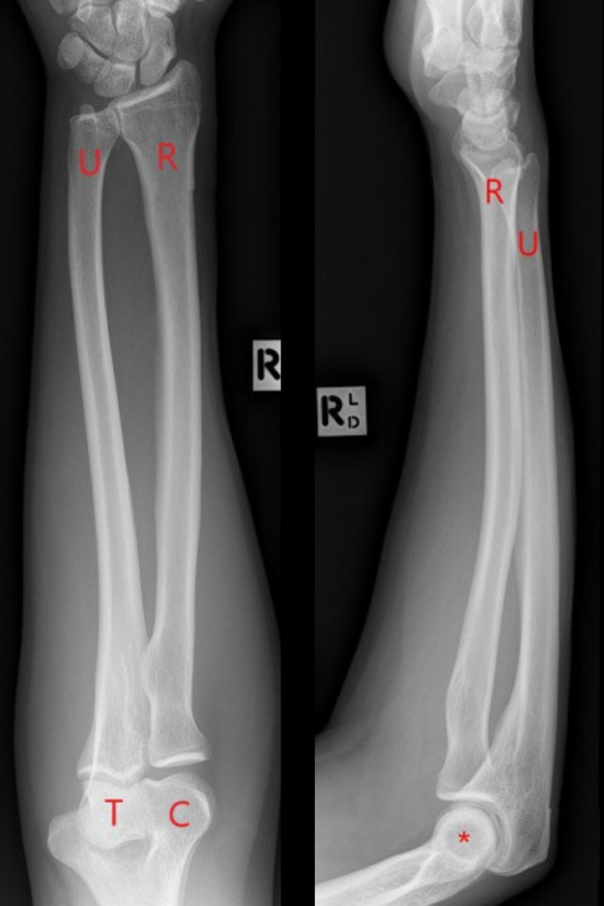Midshaft radius and ulna fractures