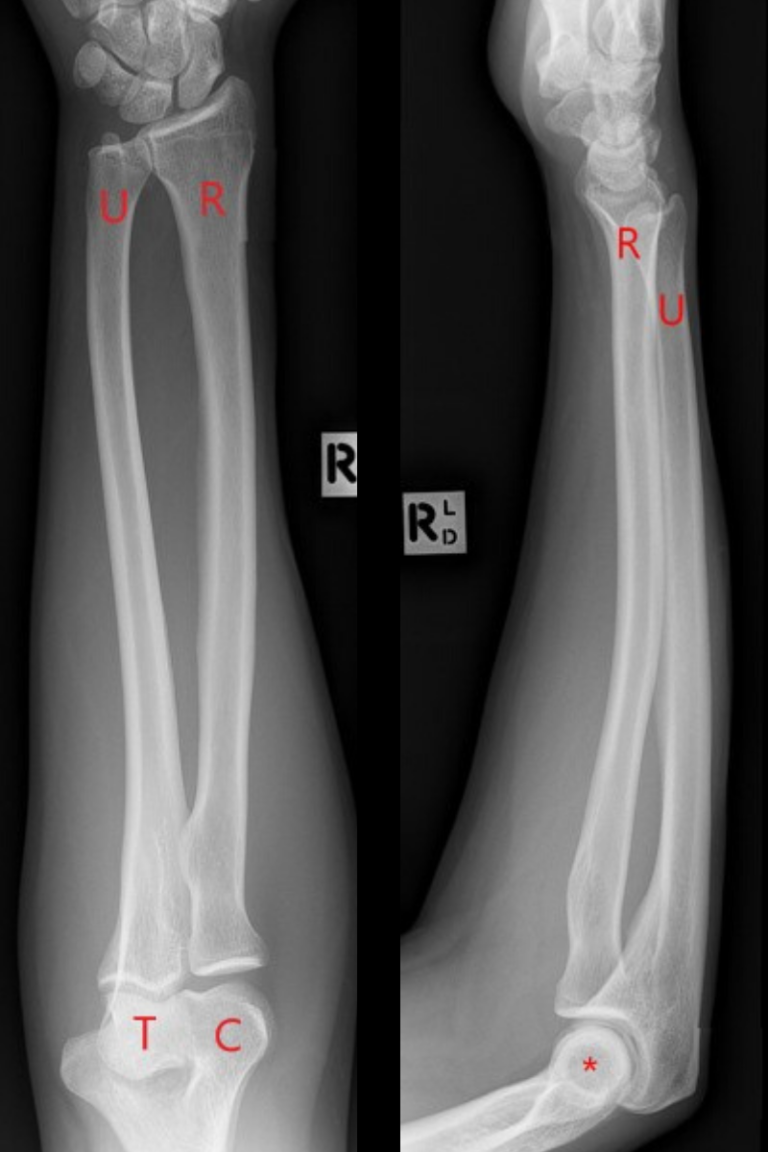 Midshaft radius and ulna fractures