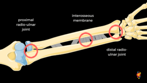 Midshaft radius and ulna fractures