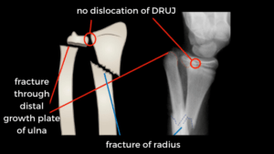 Galeazzi fracture-dislocations