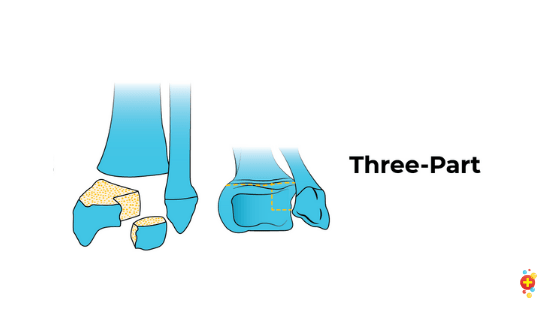 Triplane ankle fractures
