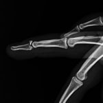 Finger Tips - tendons and ligaments