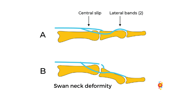 Finger Tips - tendons and ligaments