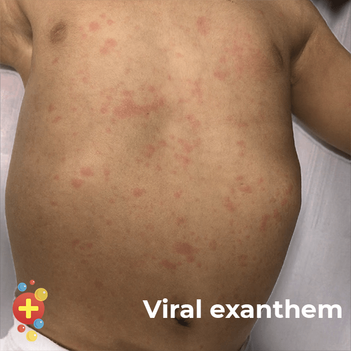 Common Rashes Module