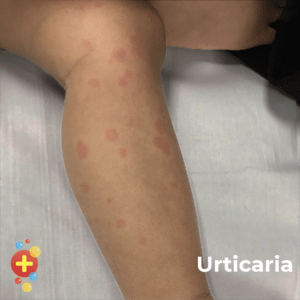 Common Rashes Module - Don't Forget the Bubbles