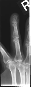 Finger injuries: basics and bones