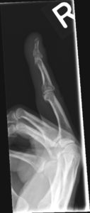 Finger injuries: basics and bones