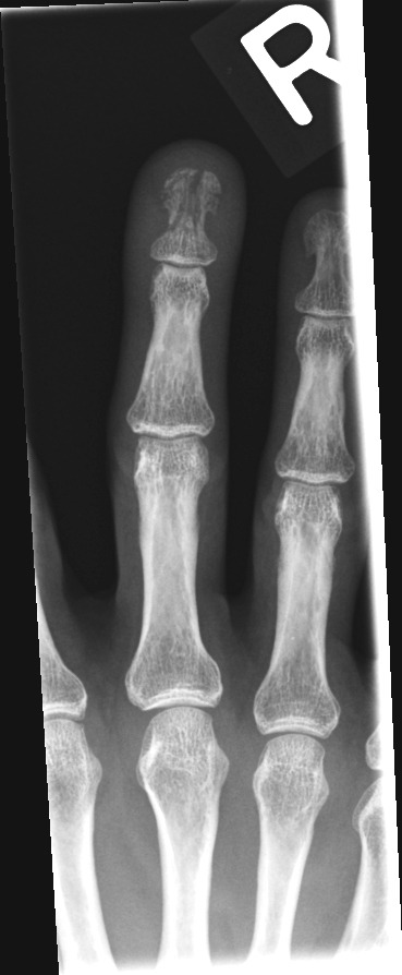 Finger injuries: basics and bones - Don't Forget the Bubbles