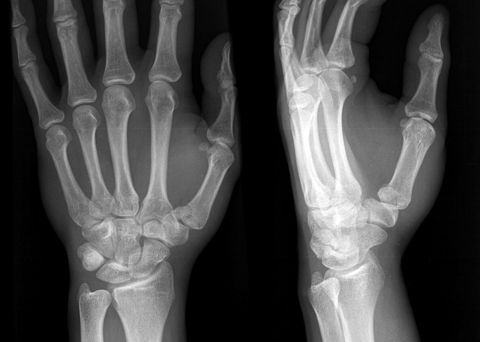 Finger injuries: basics and bones - Don't Forget the Bubbles