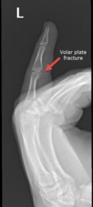 Finger injuries: basics and bones
