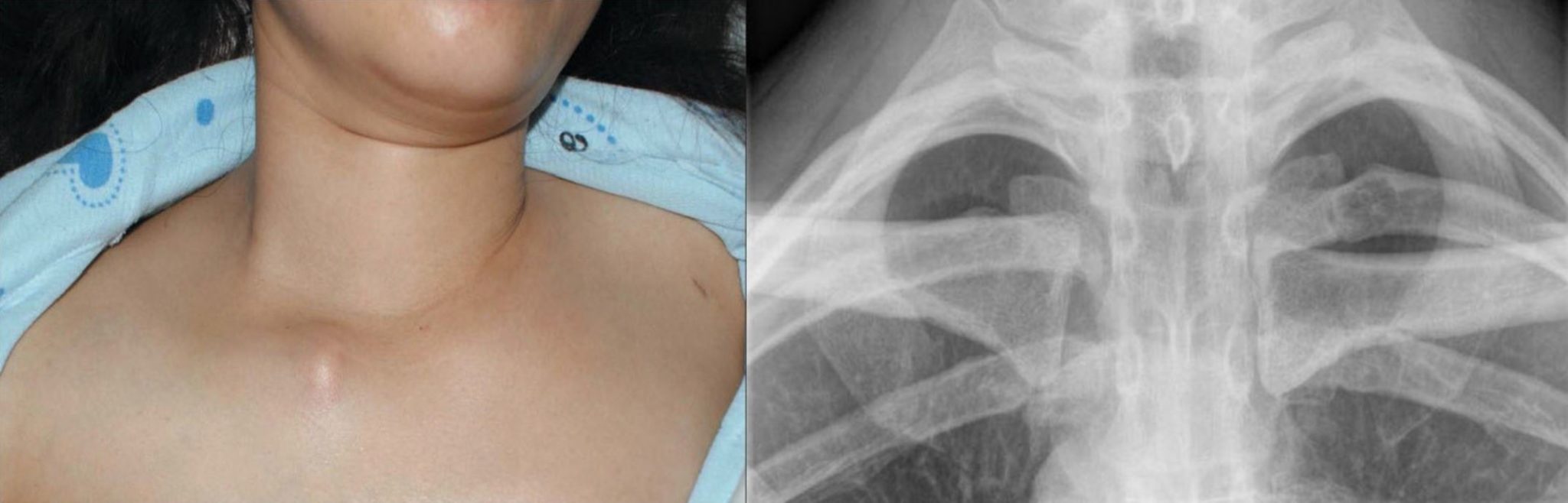 Clavicle fractures