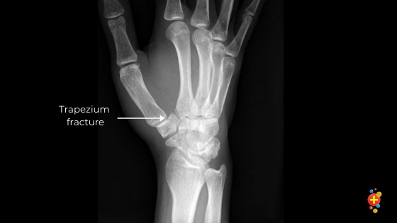 Carpal injuries - Don't Forget the Bubbles