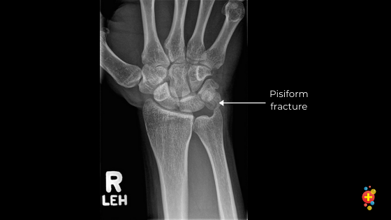 Carpal injuries - Don't Forget the Bubbles