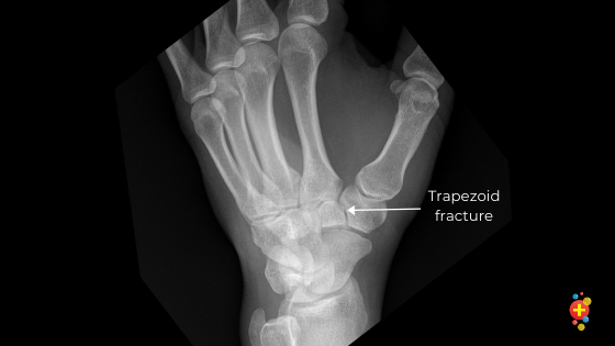 Carpal injuries - Don't Forget the Bubbles