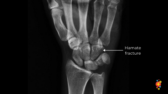 Carpal injuries - Don't Forget the Bubbles