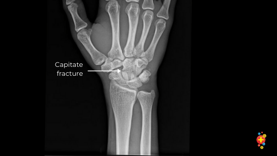 Carpal injuries - Don't Forget the Bubbles