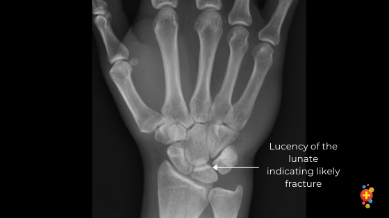 Carpal injuries - Don't Forget the Bubbles