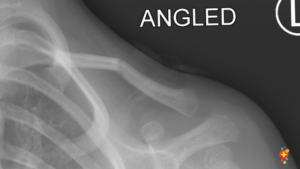 Clavicle fractures