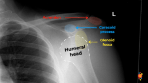 Shoulder x-ray interpretation