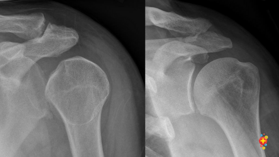 Shoulder x-ray interpretation - Don't Forget the Bubbles