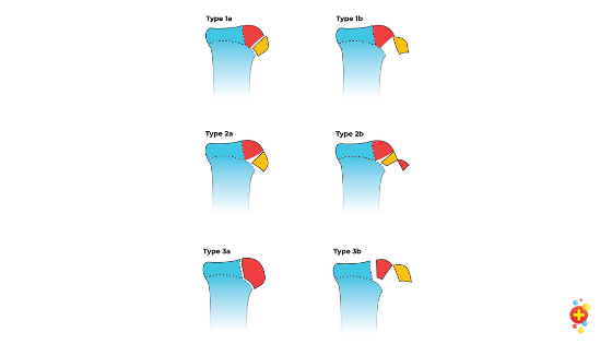 Proximal Tibial Fractures - Don't Forget the Bubbles