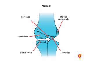Lateral condylar fractures of the humerus