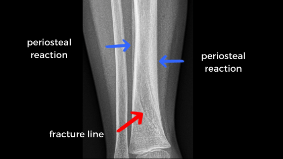 Toddler fracture - Don't Forget the Bubbles