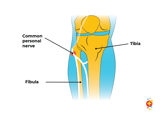 Fibula fractures - Don't Forget the Bubbles