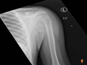 Proximal humeral fractures