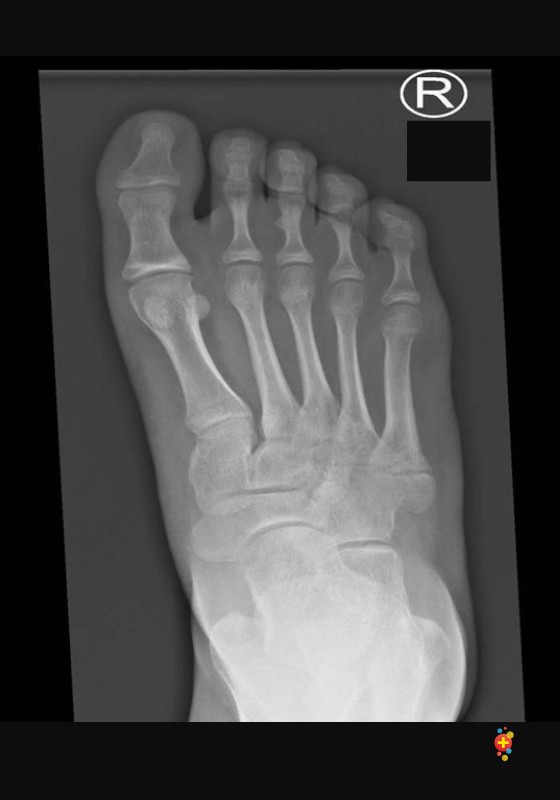 Foot and toe injuries - Don't Forget the Bubbles