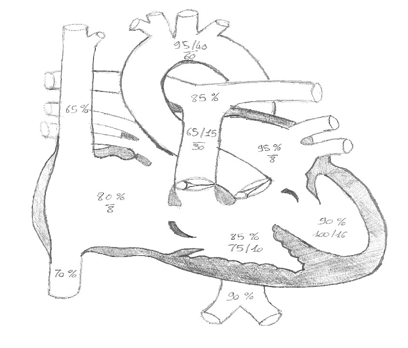 Atrioventricular septal defect (AVSD) - Don't Forget the Bubbles